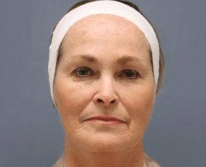 Image Pro SUNLITE: Detailed Skin Analysis | Emage Medical